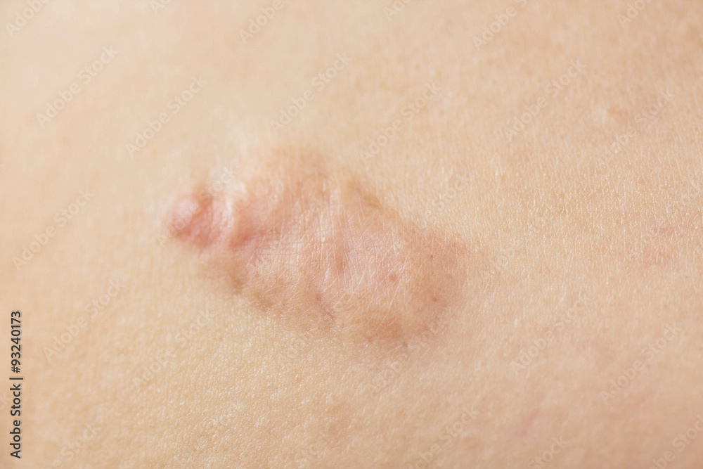 scars on the skin Stock Photo | Adobe Stock