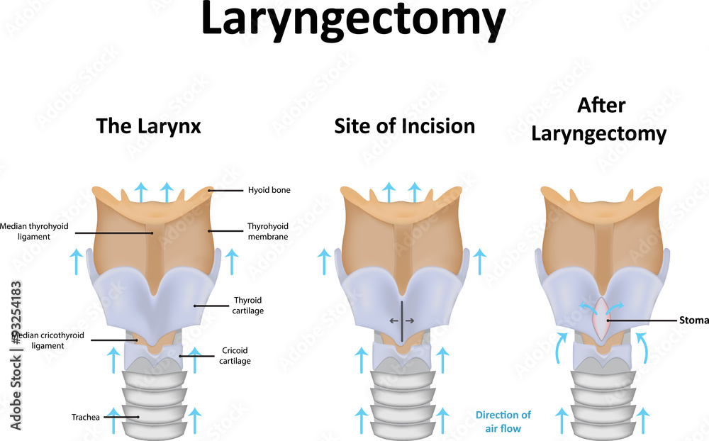 Laryngectomy Illustration Stock Vector | Adobe Stock