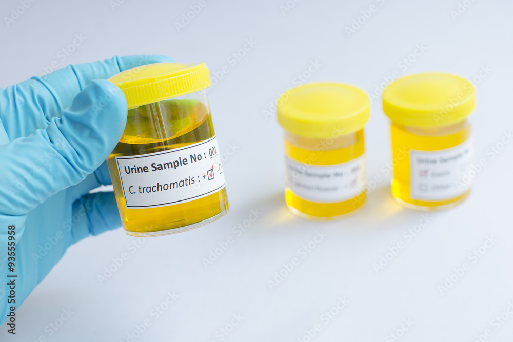 Urine sample positive with Chlamydia trachomatis bacteria Stock Photo ...