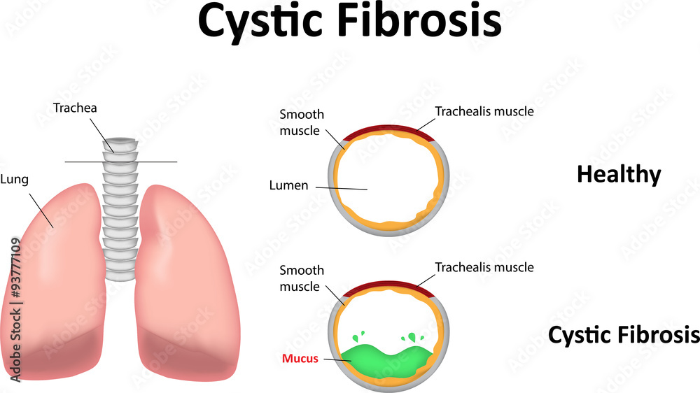 Cystic Fibrosis Lungs Diagram