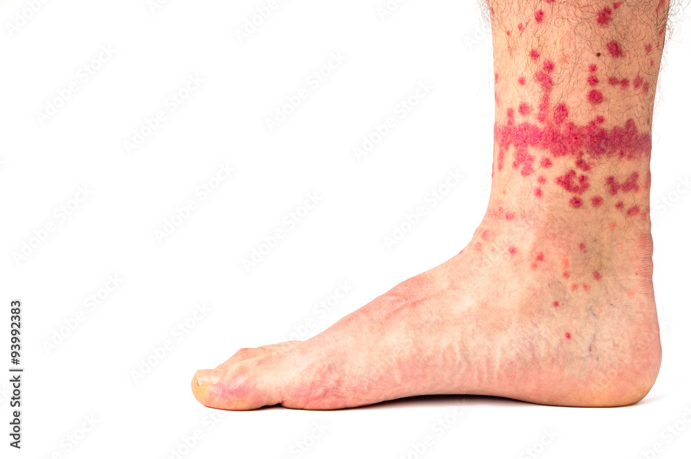 Foto Stock Flea Bites on Human Leg | Adobe Stock