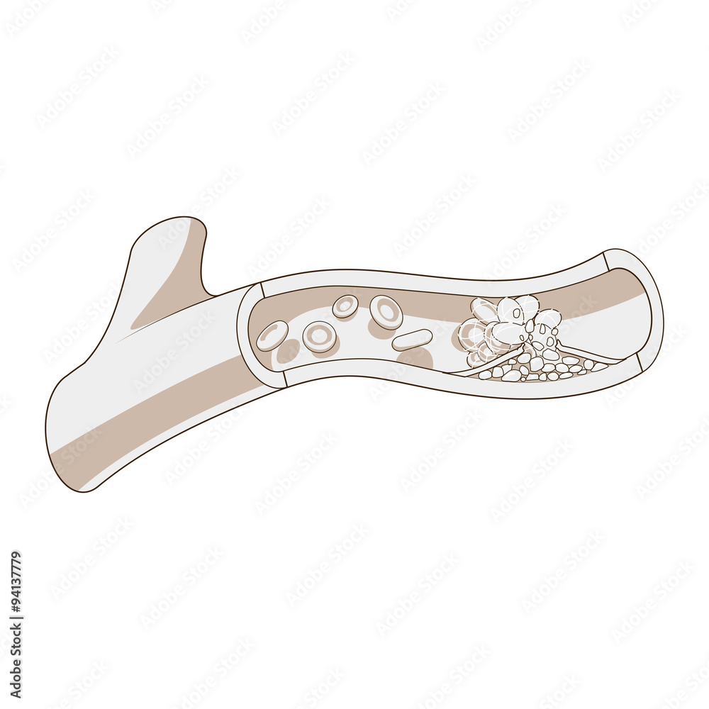 Blood vessel and clot thrombus vector illustration Stock Vector | Adobe ...