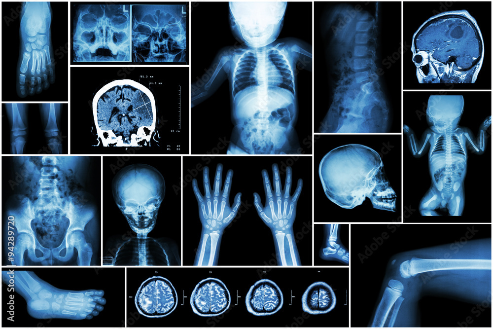 X-ray multiple part of child 's body & multiple disease ( stroke ...