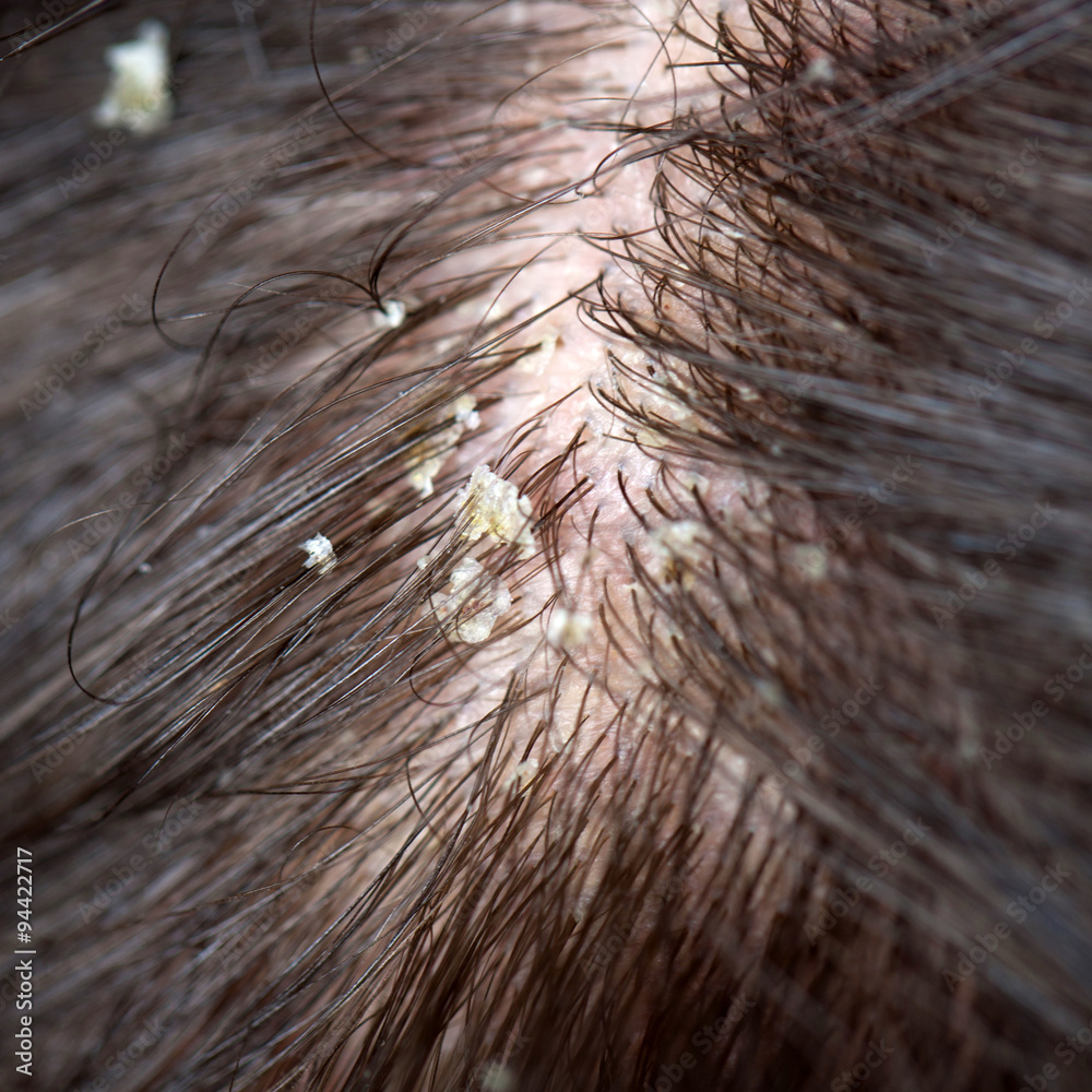 Dandruff in the hair. Flaky scalp. Photos | Adobe Stock