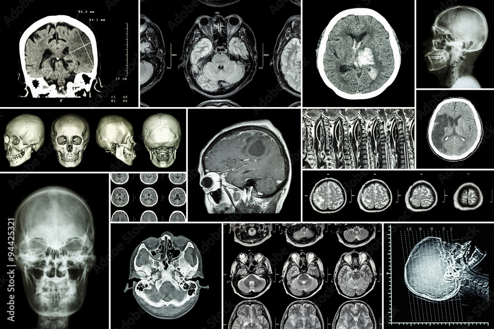 Set , Collection of brain disease ( Cerebral infarction , Hemorrhagic ...