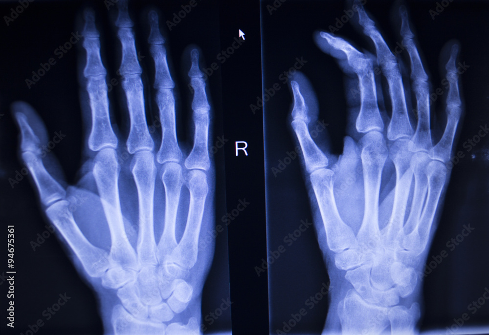 X-ray orthopedics Traumatology scan of hand finger injury Stock Photo ...