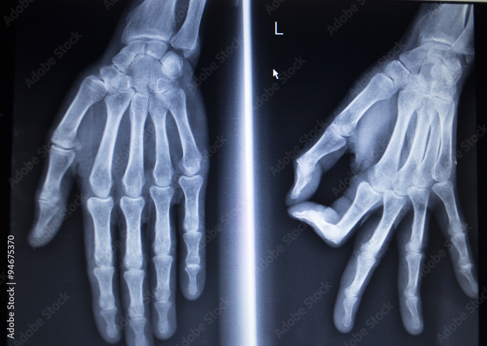 X-ray orthopedics Traumatology scan of hand finger injury Stock Photo ...