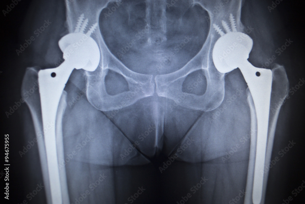 X-ray scan image of hip joint replacement orthopedic implant Stock ...