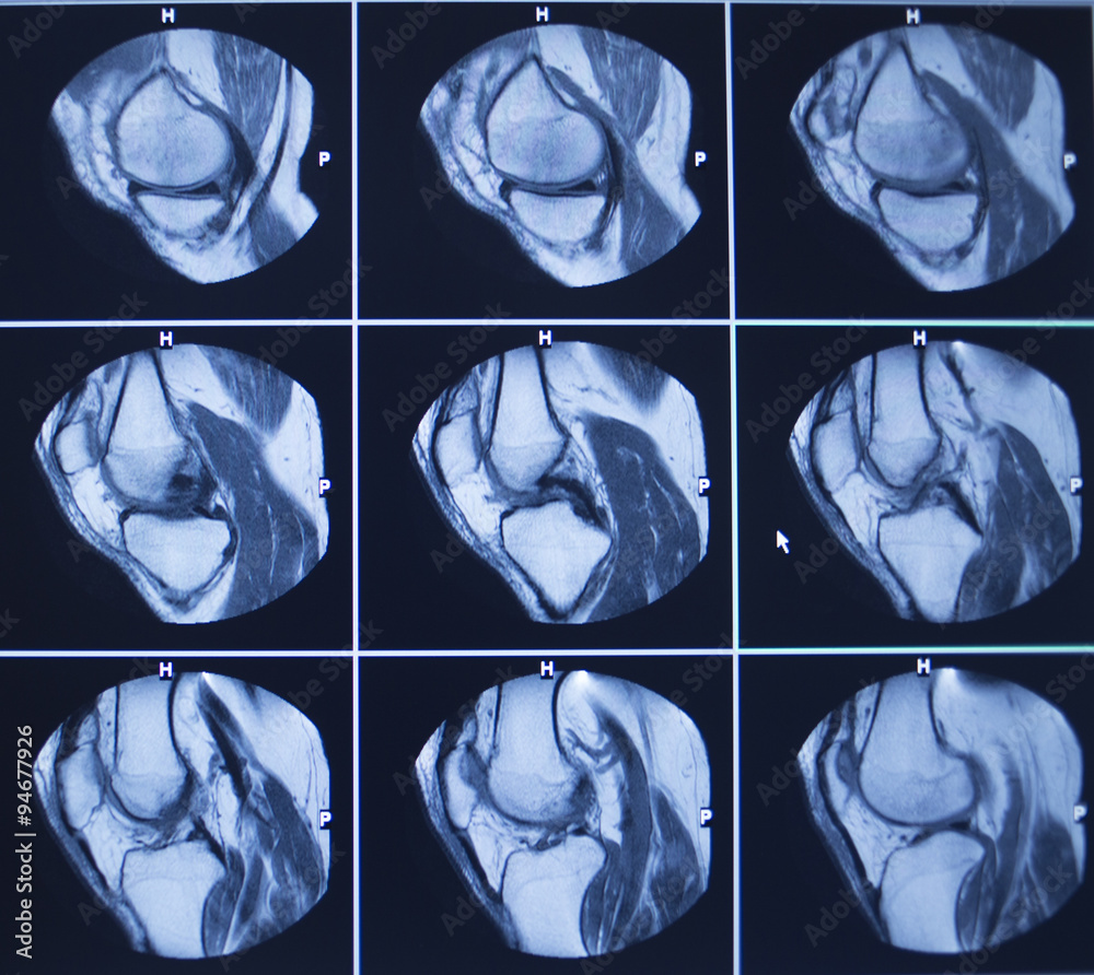 Foto de MRI scan test results knee meniscus injury do Stock | Adobe Stock