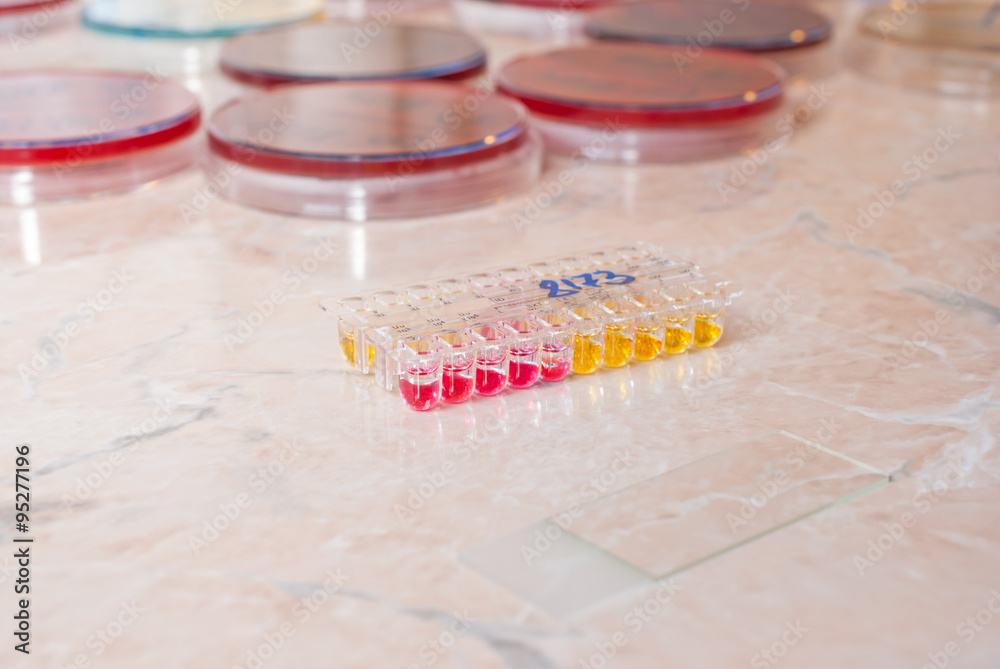 Urine test for Mycoplasma and Ureaplasma urealyticum, this is showing a ...
