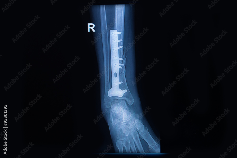 film x-ray ankle show fracture distal tibia Stock Photo | Adobe Stock