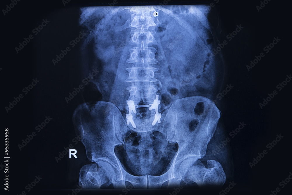Lumbar Osteosynthesis ,lumbar spinal column with internal fixati Stock ...