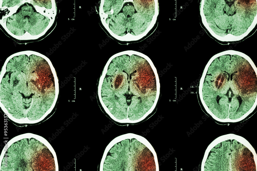 Ischemic stroke : ( CT of brain show cerebral infarction at left ...