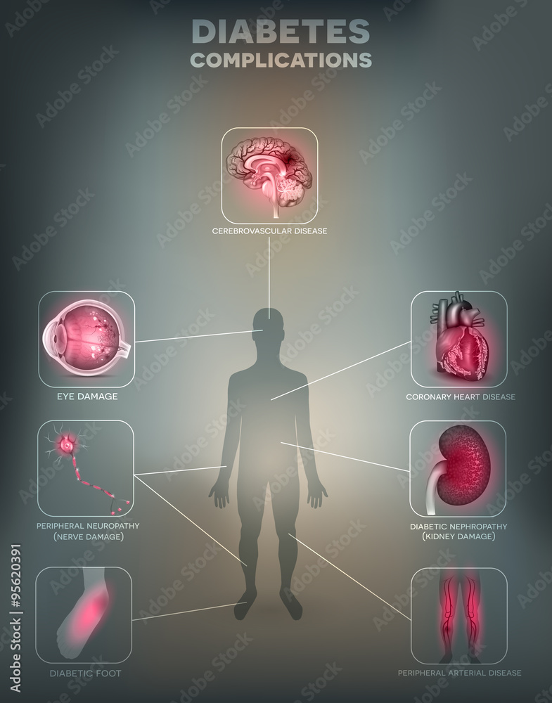 Diabetes affected organs Stock Vector | Adobe Stock