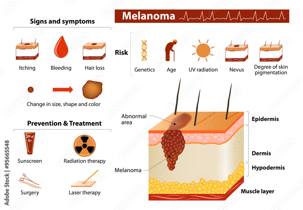 Skin cancer infographics Stock Vector | Adobe Stock