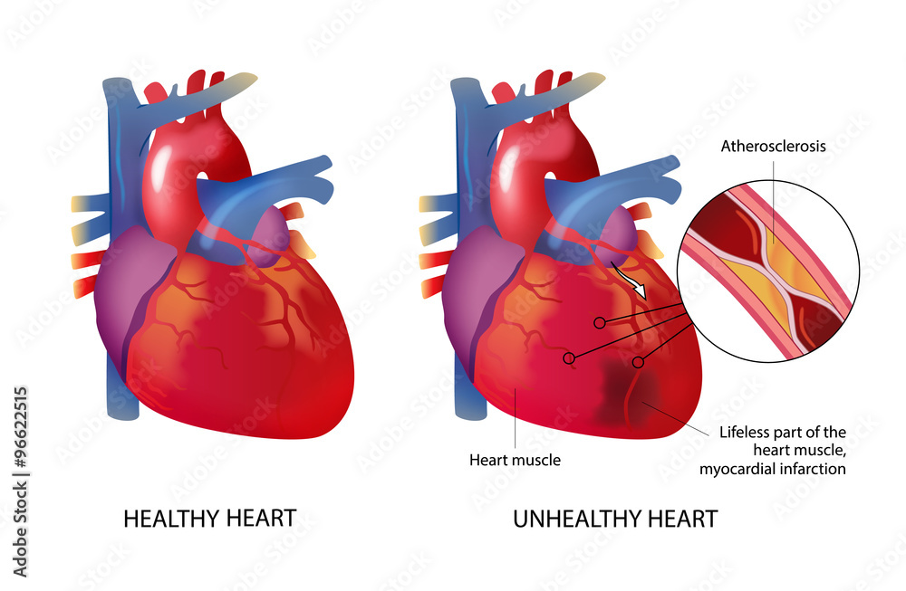 Real Unhealthy Heart