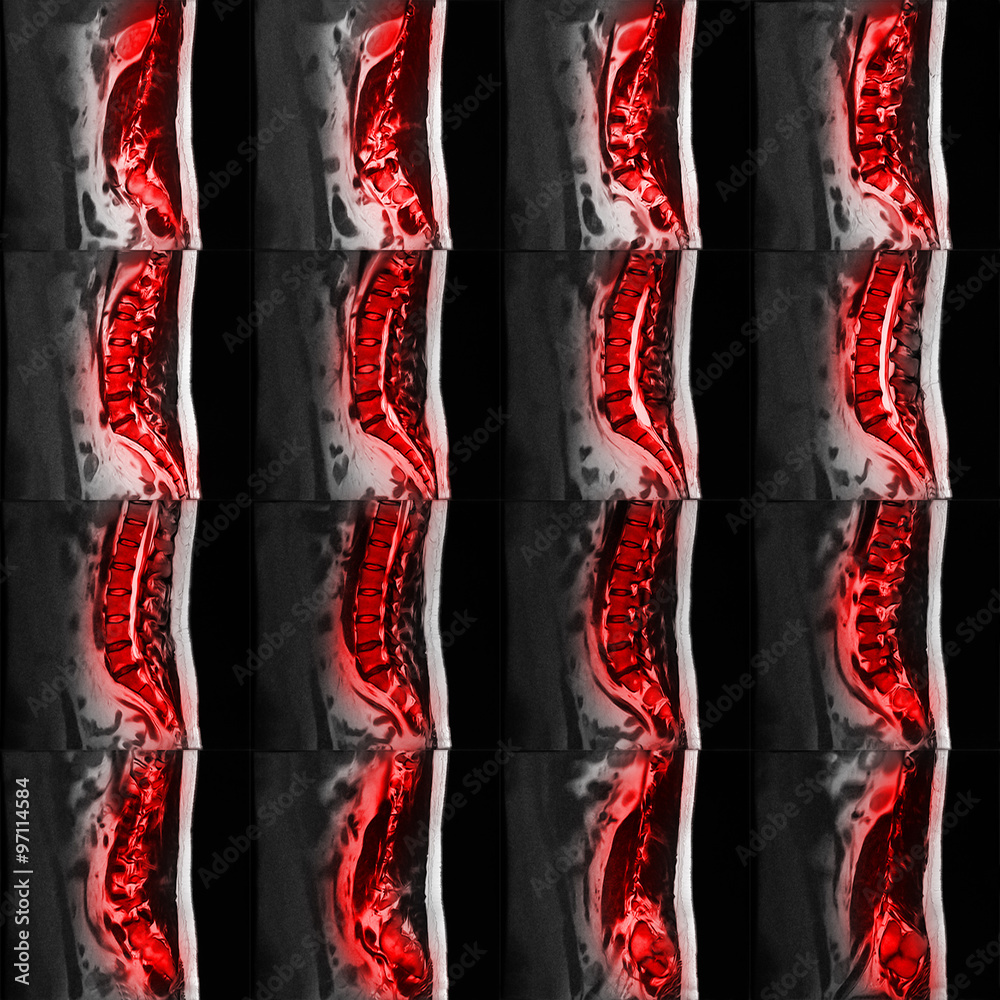 MRI Of Lumbar And Thoracic Vertebral Column Spine Showing Spinal Disc ...