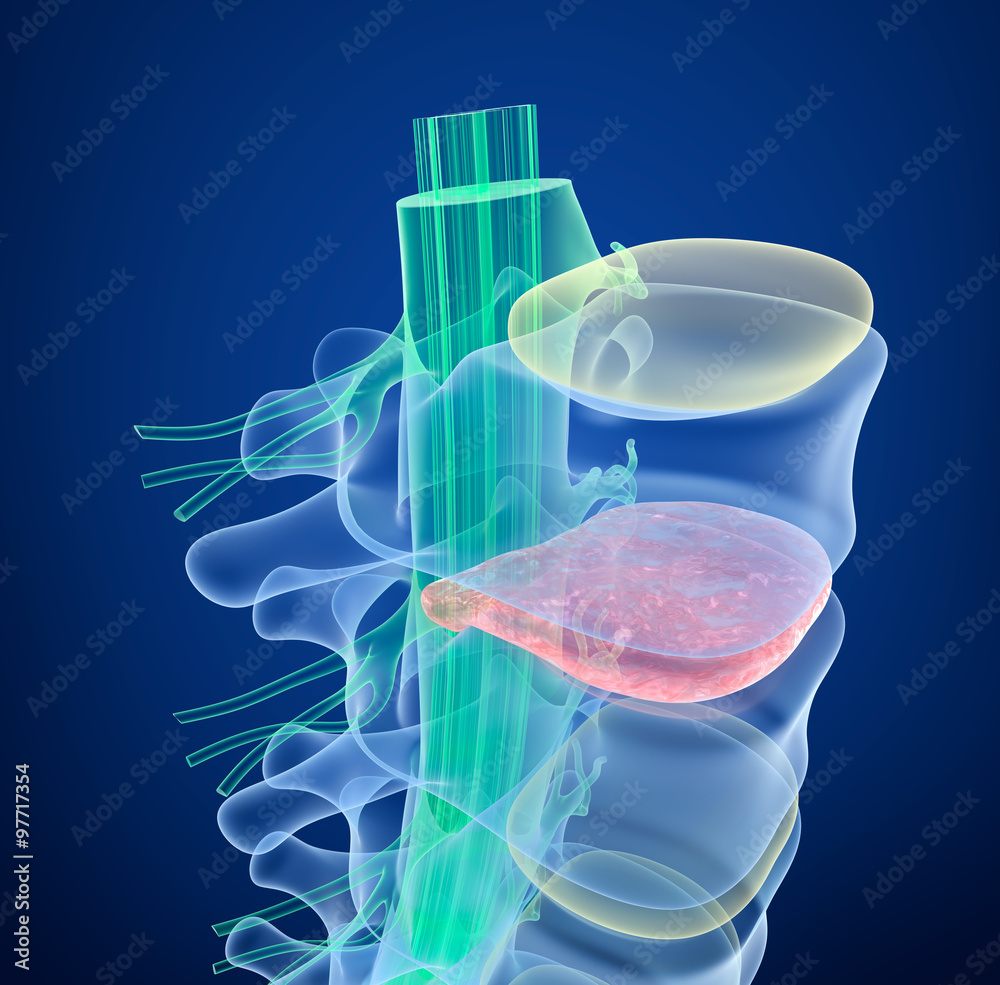 Spinal cord under pressure of bulging disc, X-Ray view. 3D illustration ...