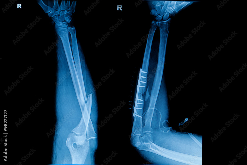 Collection of human x-rays showing fracture of radius bone , Stock ...