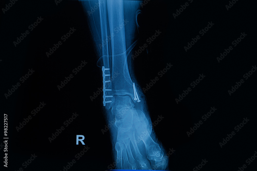 human x-rays showing fracture of right leg ( fracture both bones ...