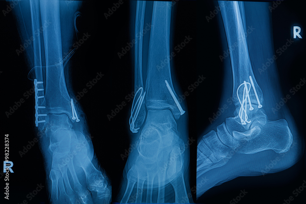 Collection of human x-rays showing fracture of right leg ( fracture ...