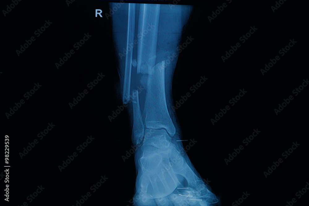 Collection of human x-rays showing fracture of right leg Stock Photo ...