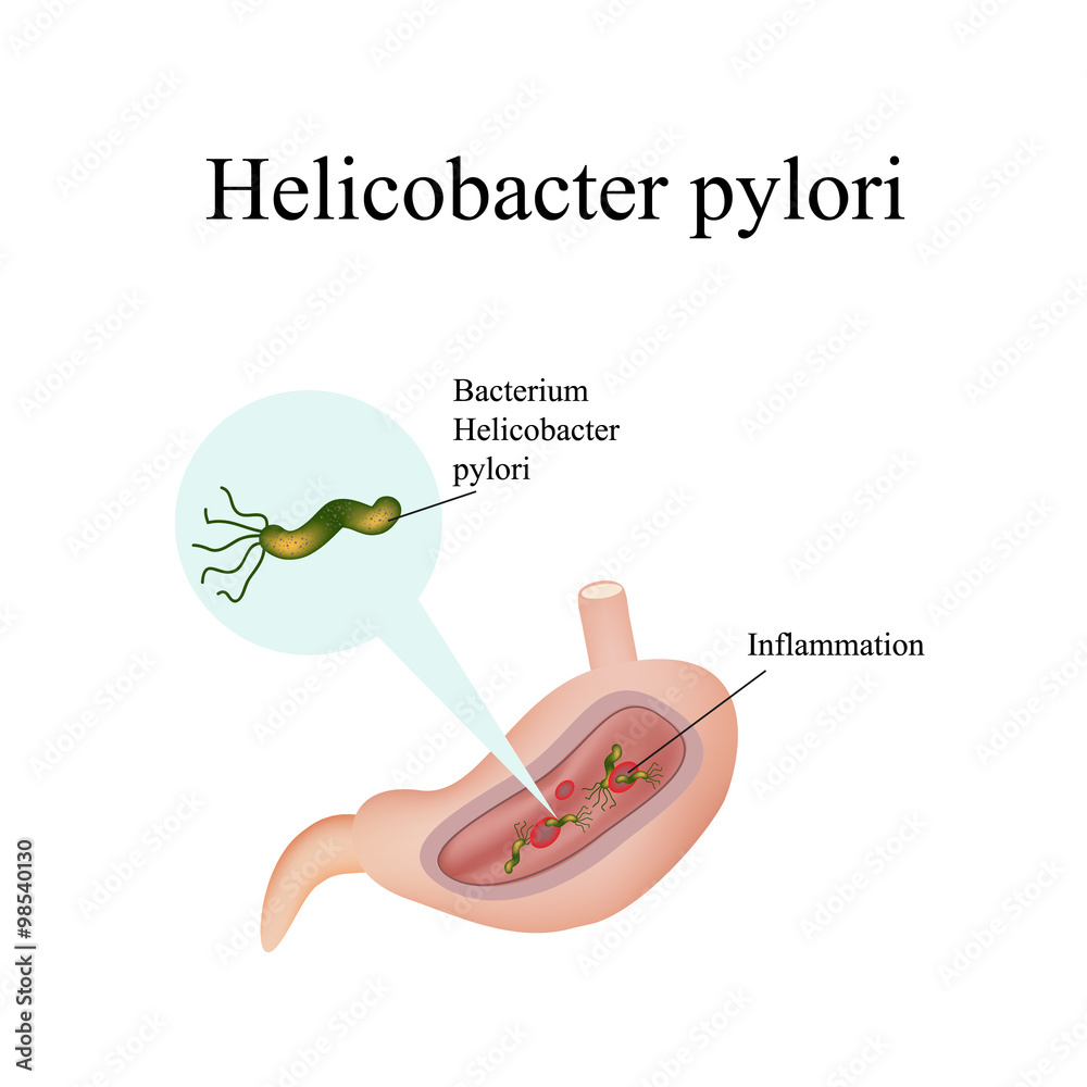 Helicobacter pylori in the stomach. Infographics. Vector illustration ...