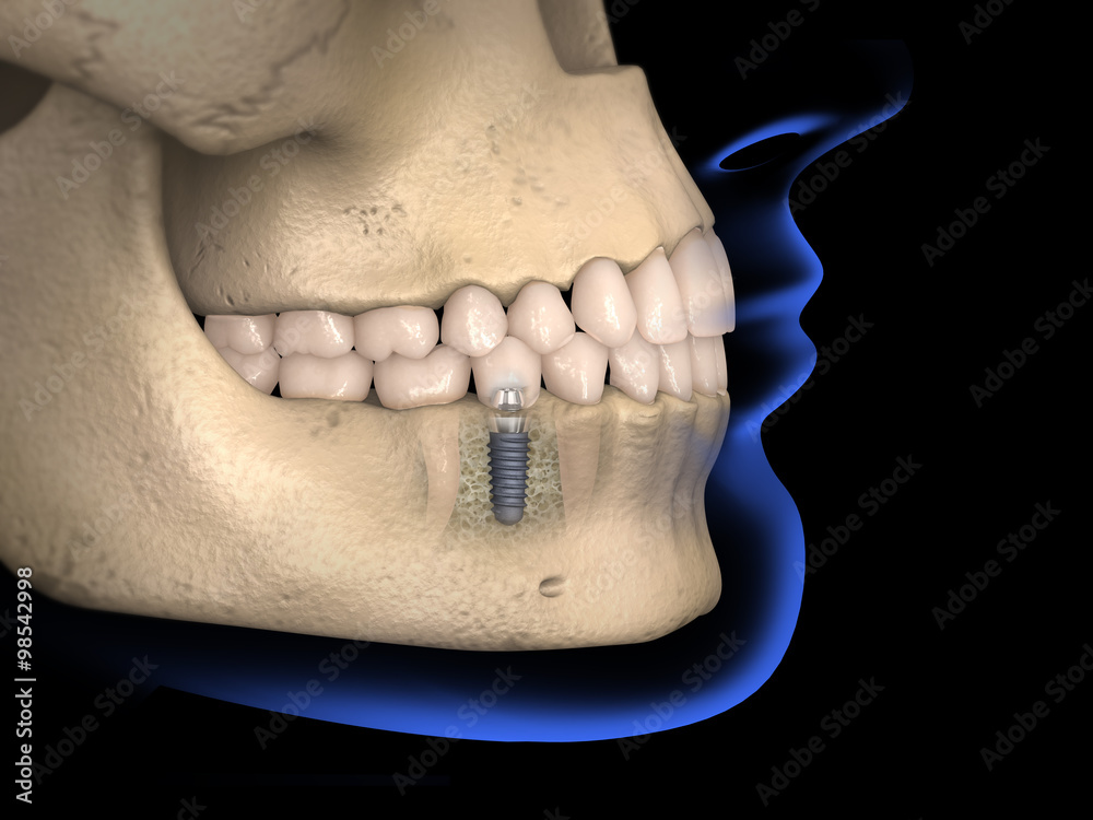 Dental anatomy - Dental implant with bone structure, upper and lower ...