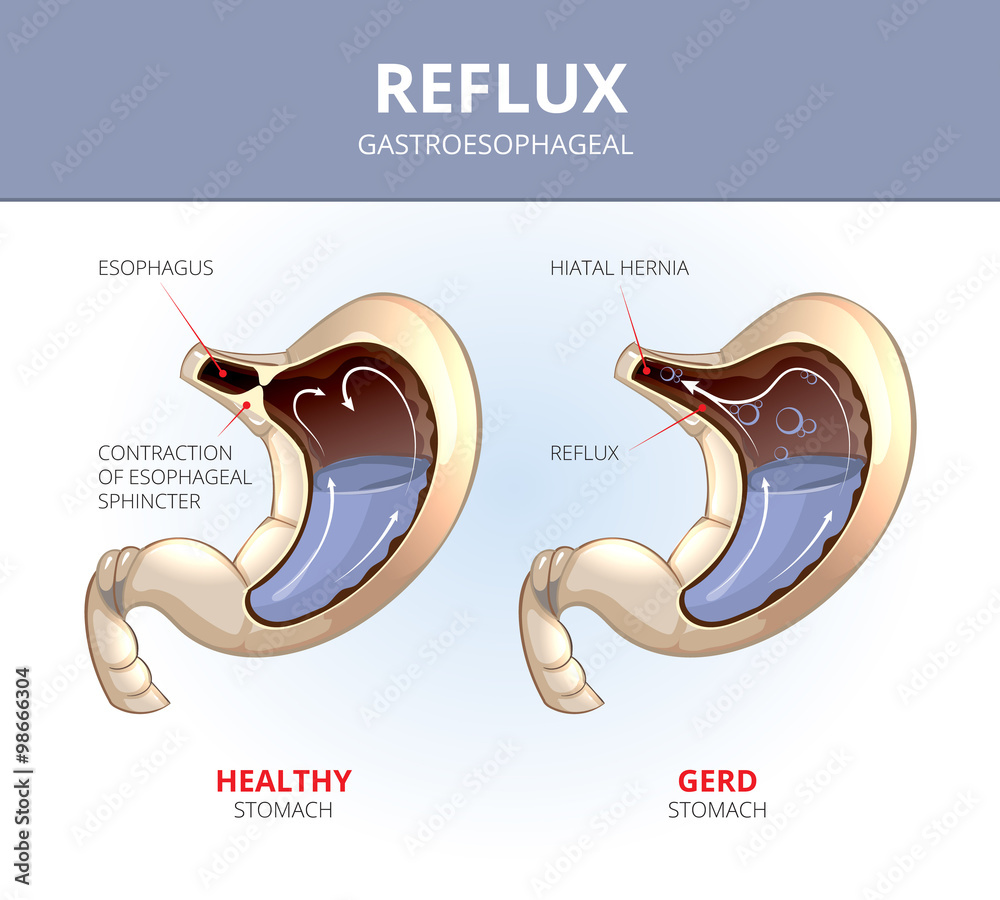 Gastroesophageal reflux disease. Healthy and sick stomach. Vector ...