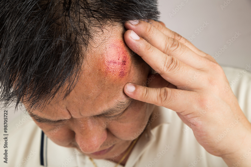 Selective focus on painful red swollen forehead injury Stock Photo ...