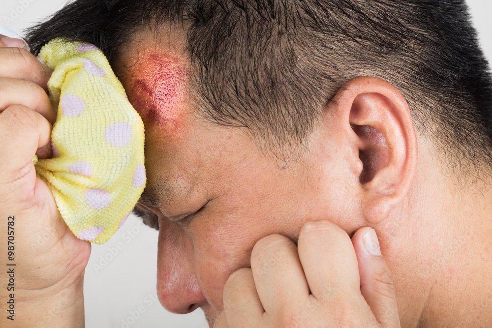 Man treating his injured painful swollen forehead bump with icepack ...