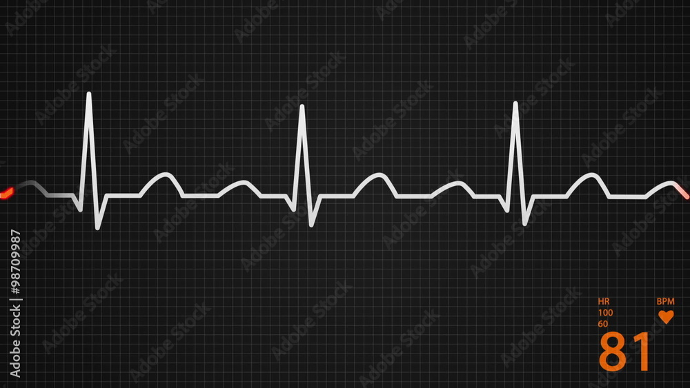 Animation of a schematic diagram of normal sinus rhythm for a human ...