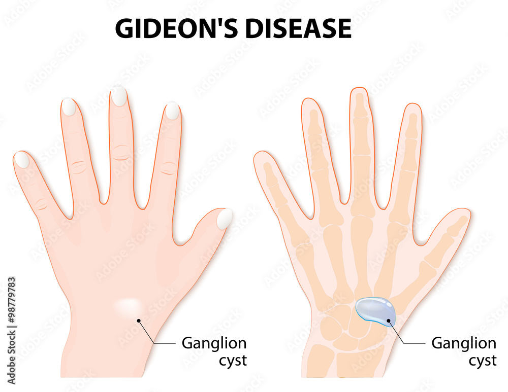 Ganglion cyst or synovial cyst Stock Vector | Adobe Stock