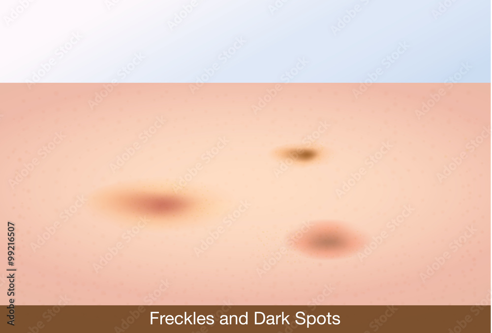 Freckles and dark spots on face skin. This illustration about skin care ...