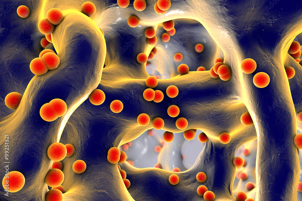 Spherical bacteria inside bone tissue, on the surface of skin or mucous ...