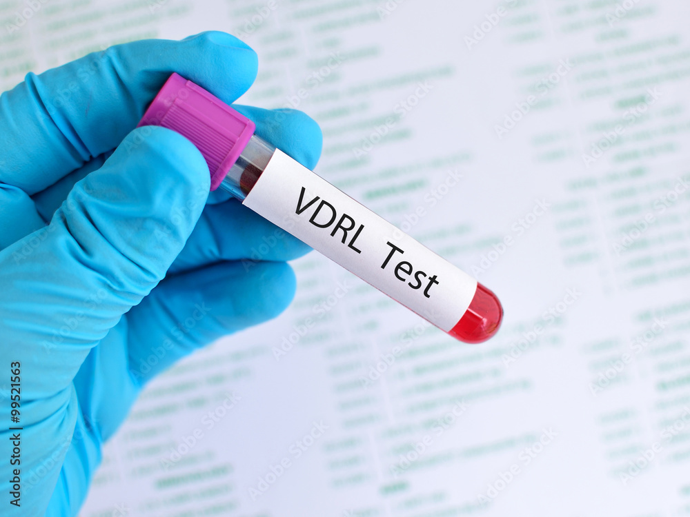 VDRL test (Syphilis disease) Stock Photo | Adobe Stock