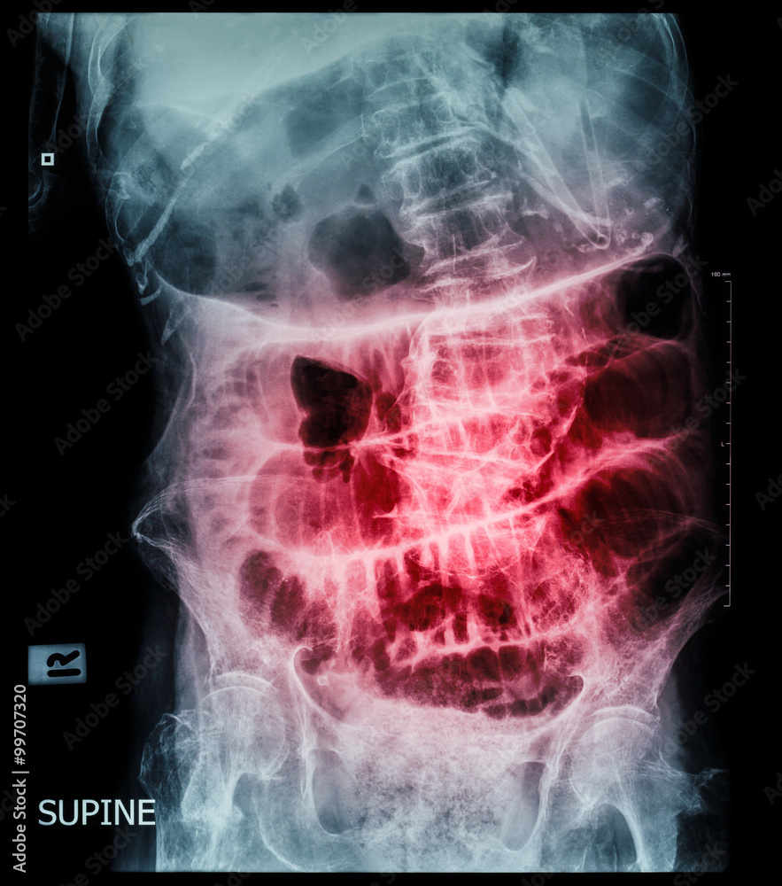Small bowel obstruction ( film x-ray abdomen ( supine position ) : show ...