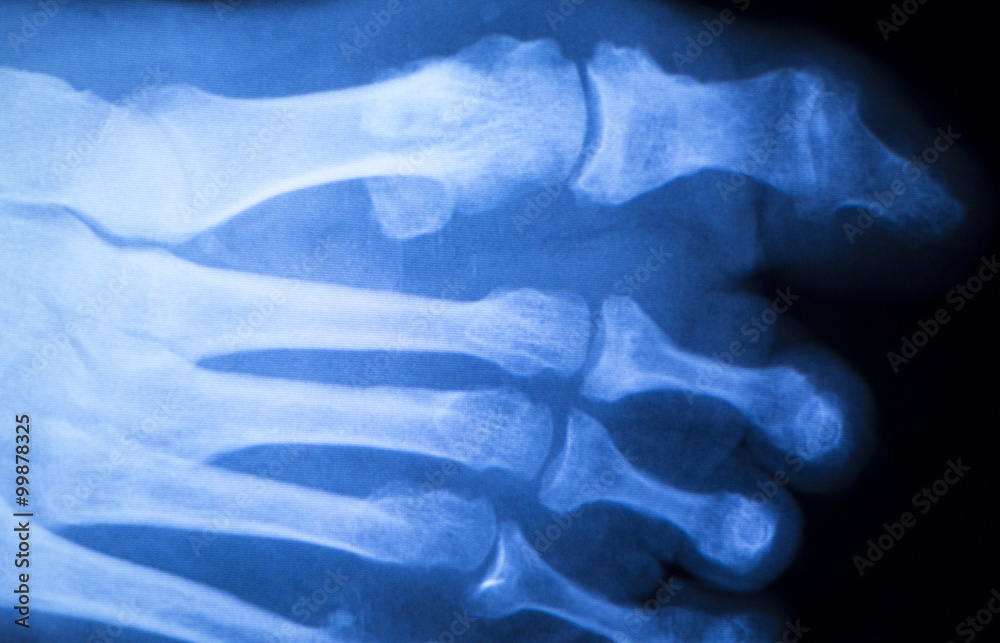 Foot and toes injury x-ray scan Stock Illustration | Adobe Stock