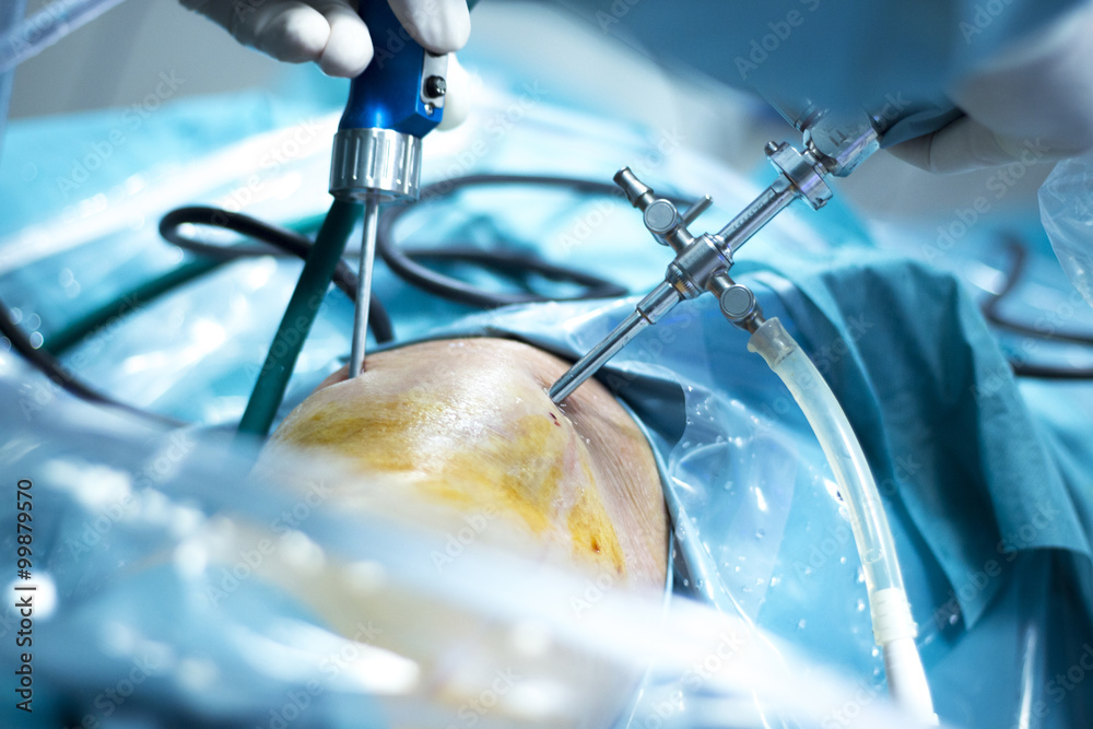 Knee arthroscopy orthopedic surgery operation Stock Photo | Adobe Stock
