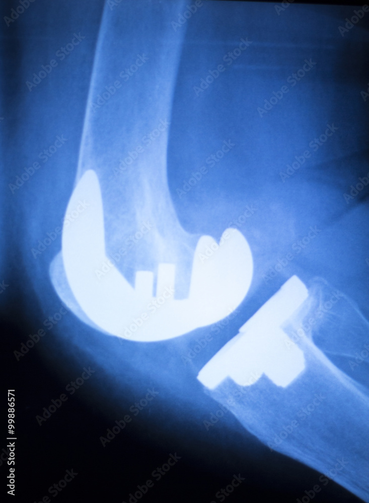 Knee joint implant x-ray test scan Stock Photo | Adobe Stock