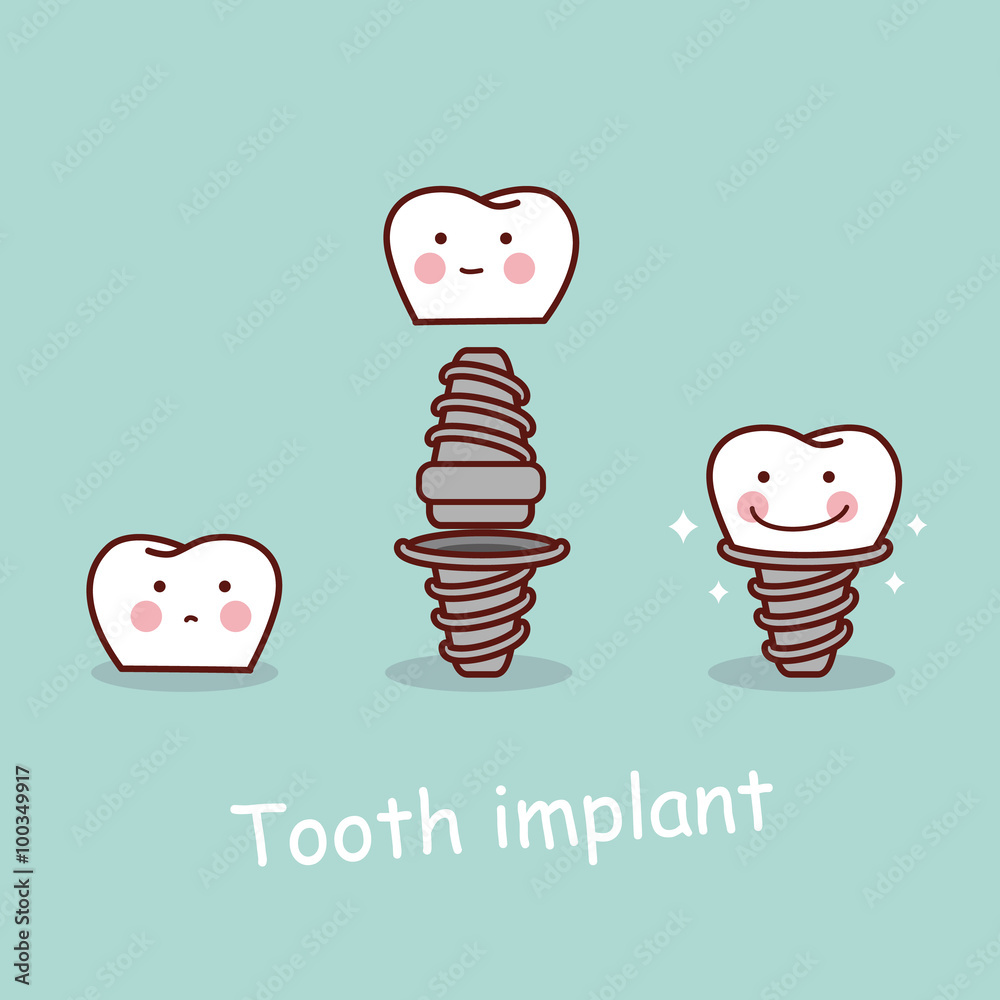 cartoon tooth dental implantation concept Stock Vector | Adobe Stock