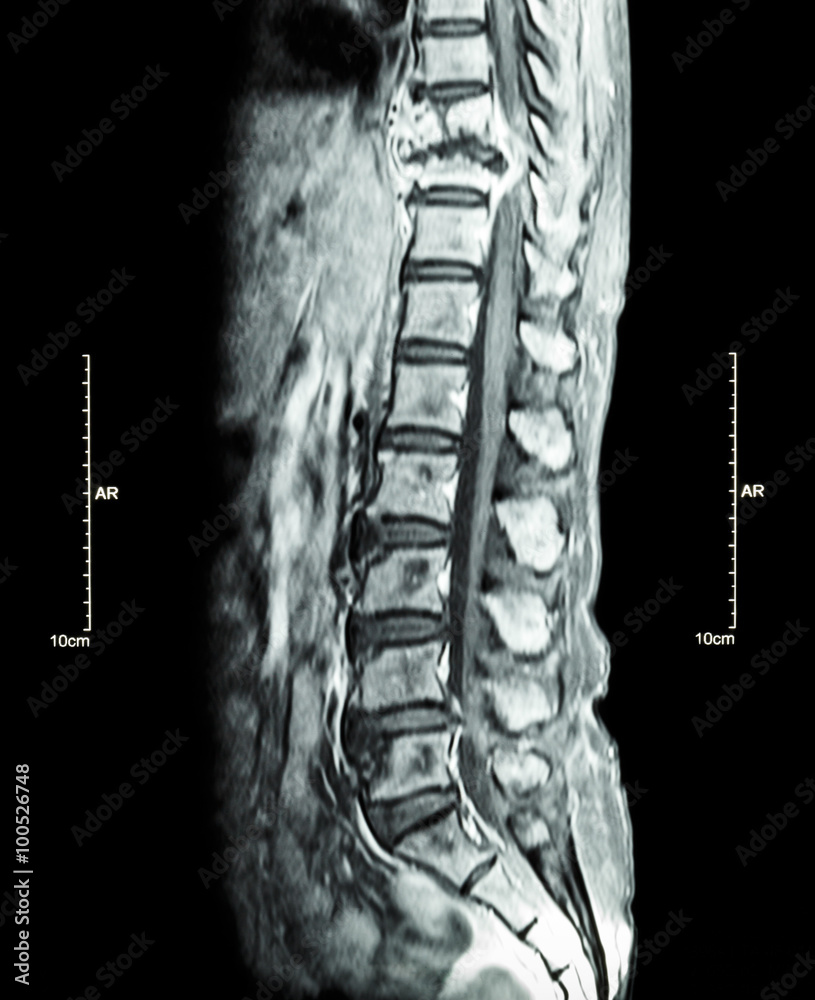 Spine metastasis ( cancer spread to thoracic spine ) ( MRI of thoracic ...