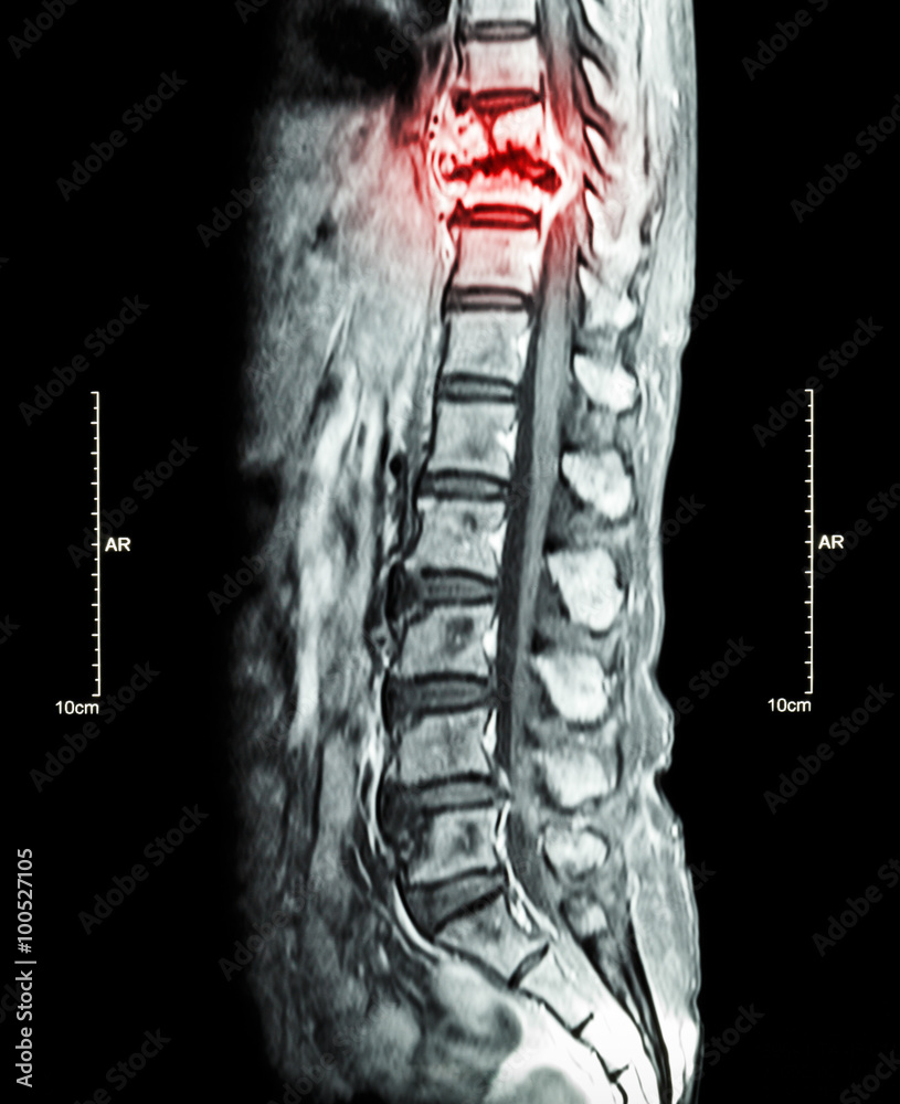 Spine metastasis ( cancer spread to thoracic spine ) ( MRI of thoracic ...