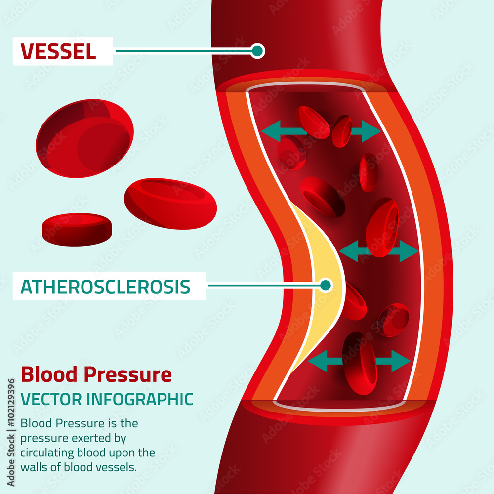 Blood Pressure Infographic Stock Vector | Adobe Stock