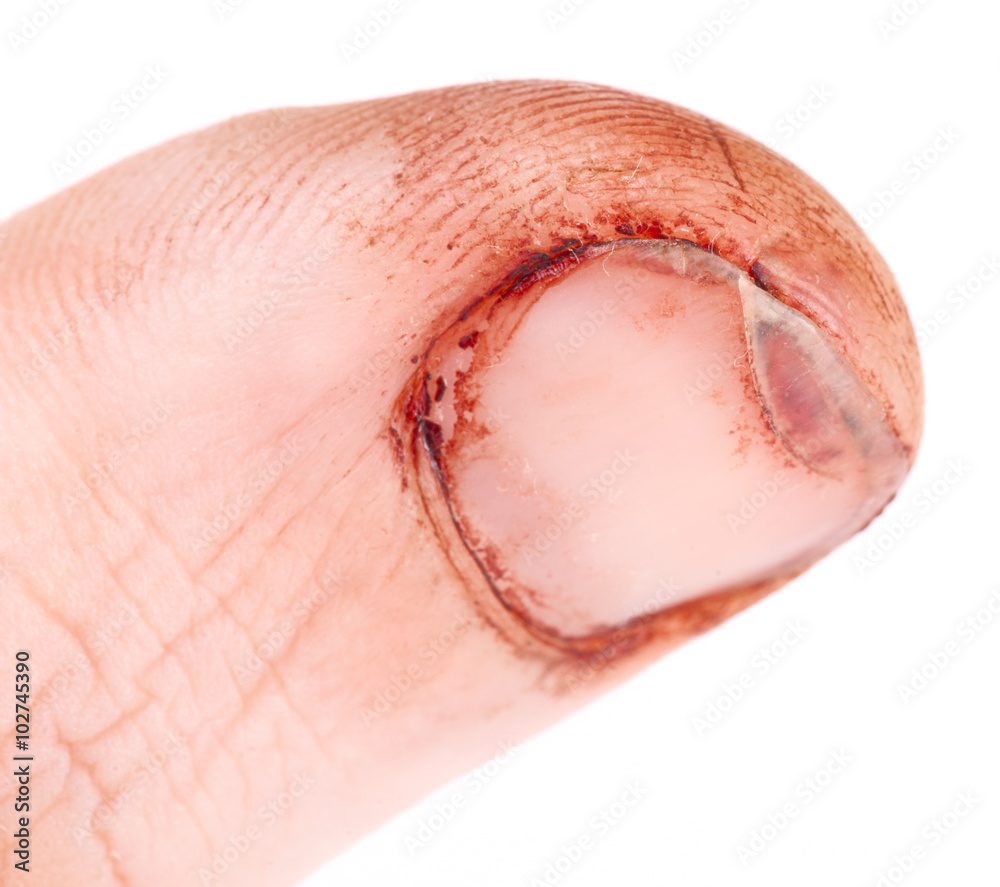 Finger cut with sharp knife Stock Photo | Adobe Stock