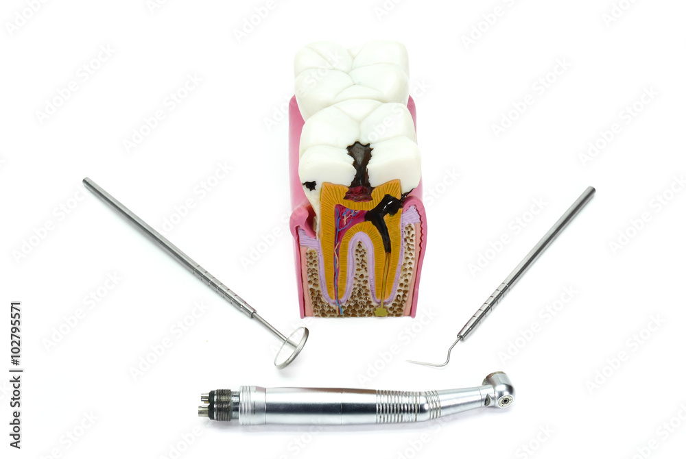 Tooth model with dental caries, abscesses and dentist's instruments ...