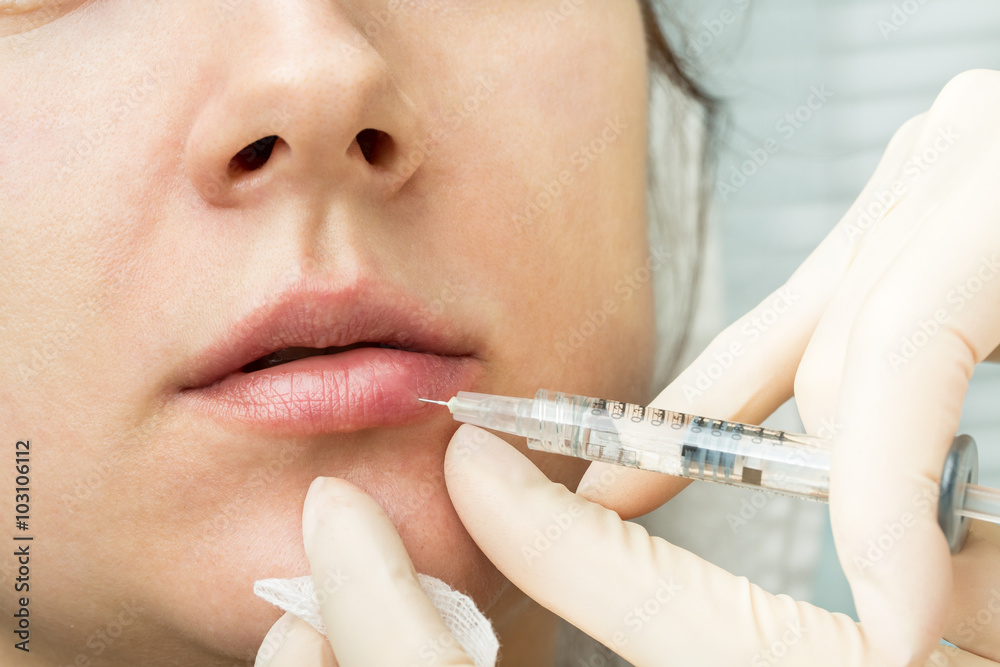 Injections for the volume and change the shape bottom lip. The real ...