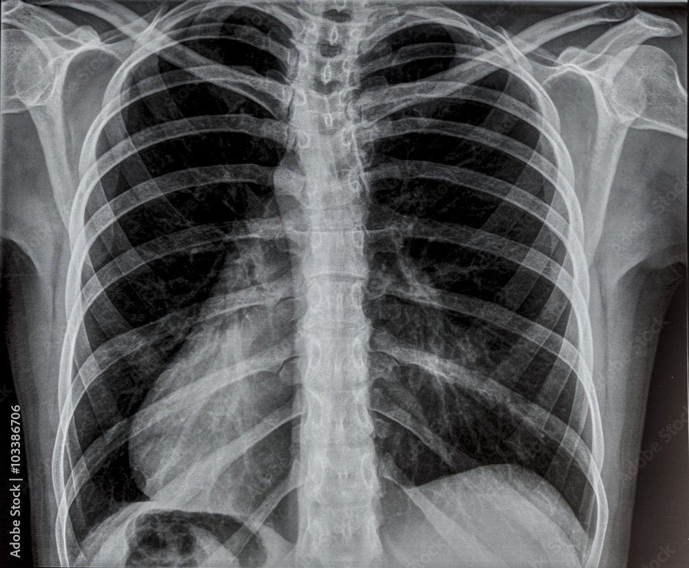 Chest x-ray Stock Photo | Adobe Stock