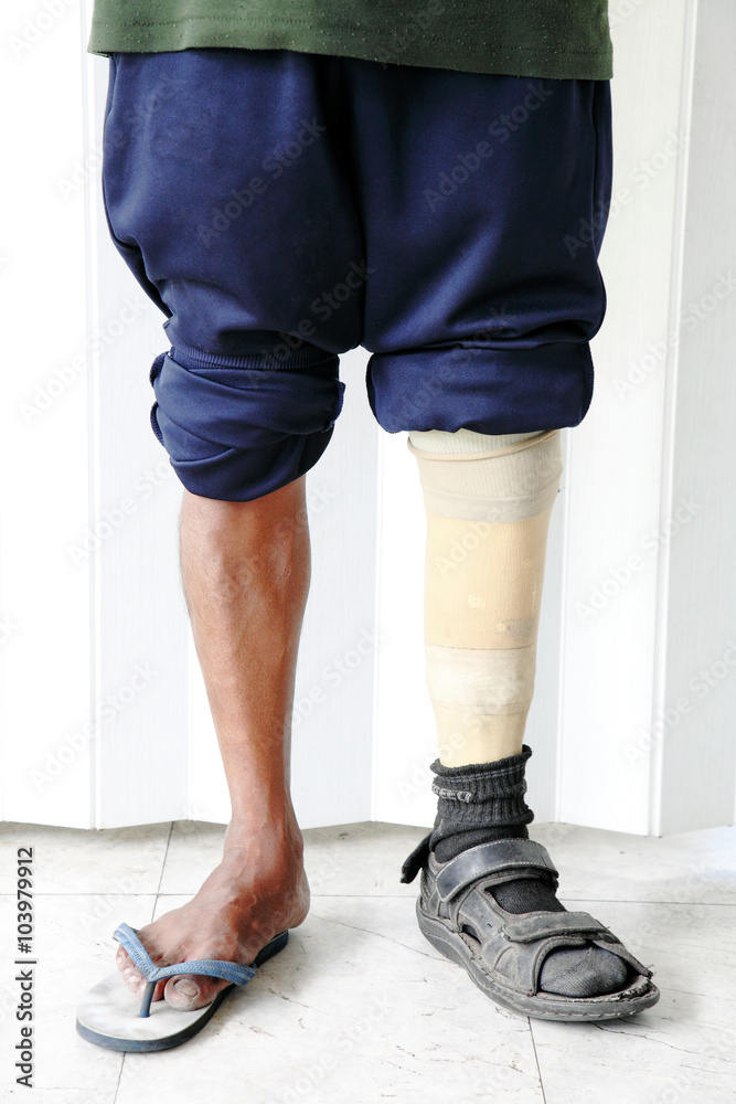 Amputee wearing a prosthetic leg standing, close up view of their leg ...