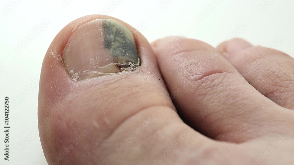 Video „Trauma of toenail. Subungual hematoma. Bruise under the nail of ...
